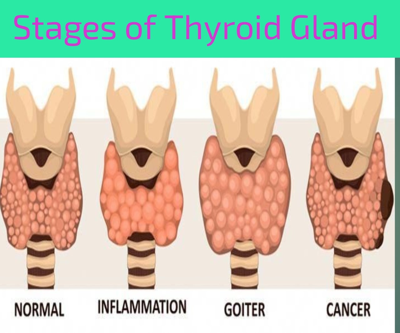 "Thyroid Cancer Uncovered: Key Causes, Symptoms and More" | | fuel for life